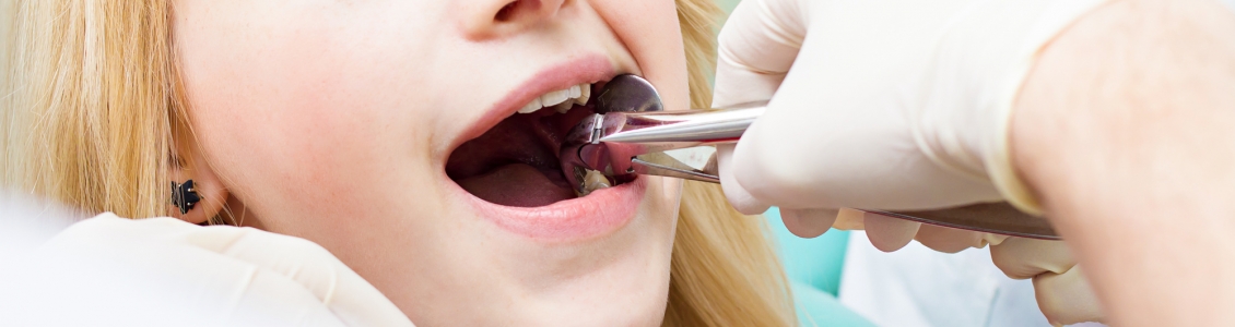 Tooth Extraction Aftercare: How to Avoid Dry Sockets After a Tooth ...